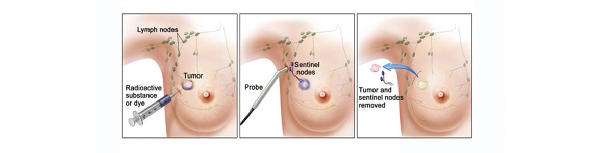 Lymph Node Biopsy Sentinel Lymph Node Biopsy For Melanoma And Surgical